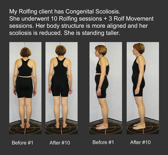 Scoliosis:What To Do?